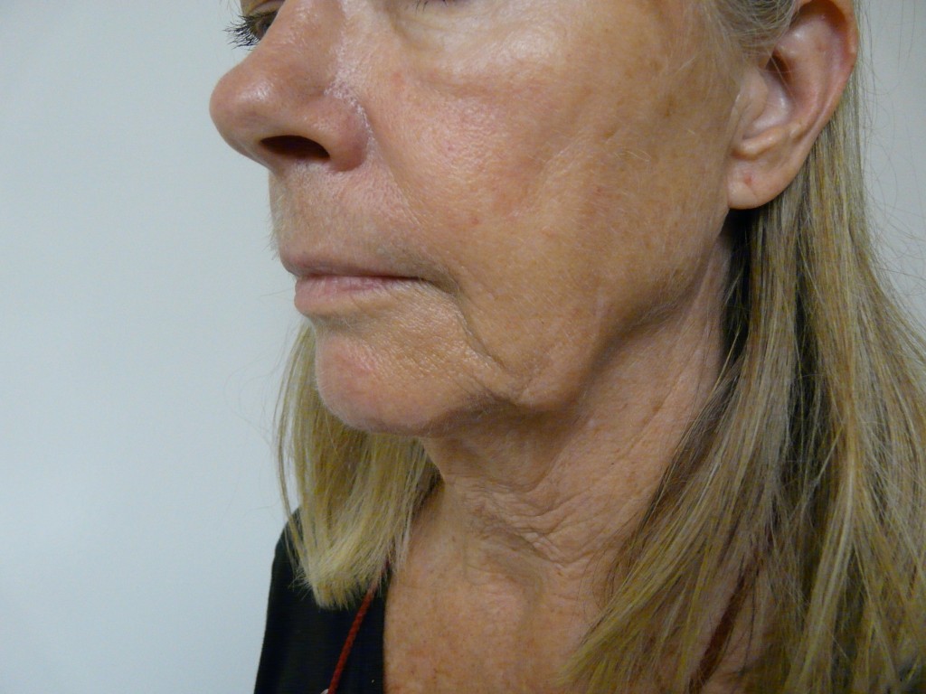 Non-Surgical Jowl Lift in Los Angeles