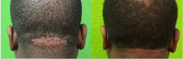 acne keloidalis nuchae - FineTouch Dermatology