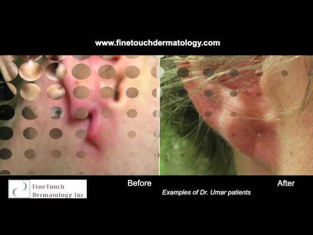 Split Earlobe Repair Surgery Solutions - FineTouch Dermatology