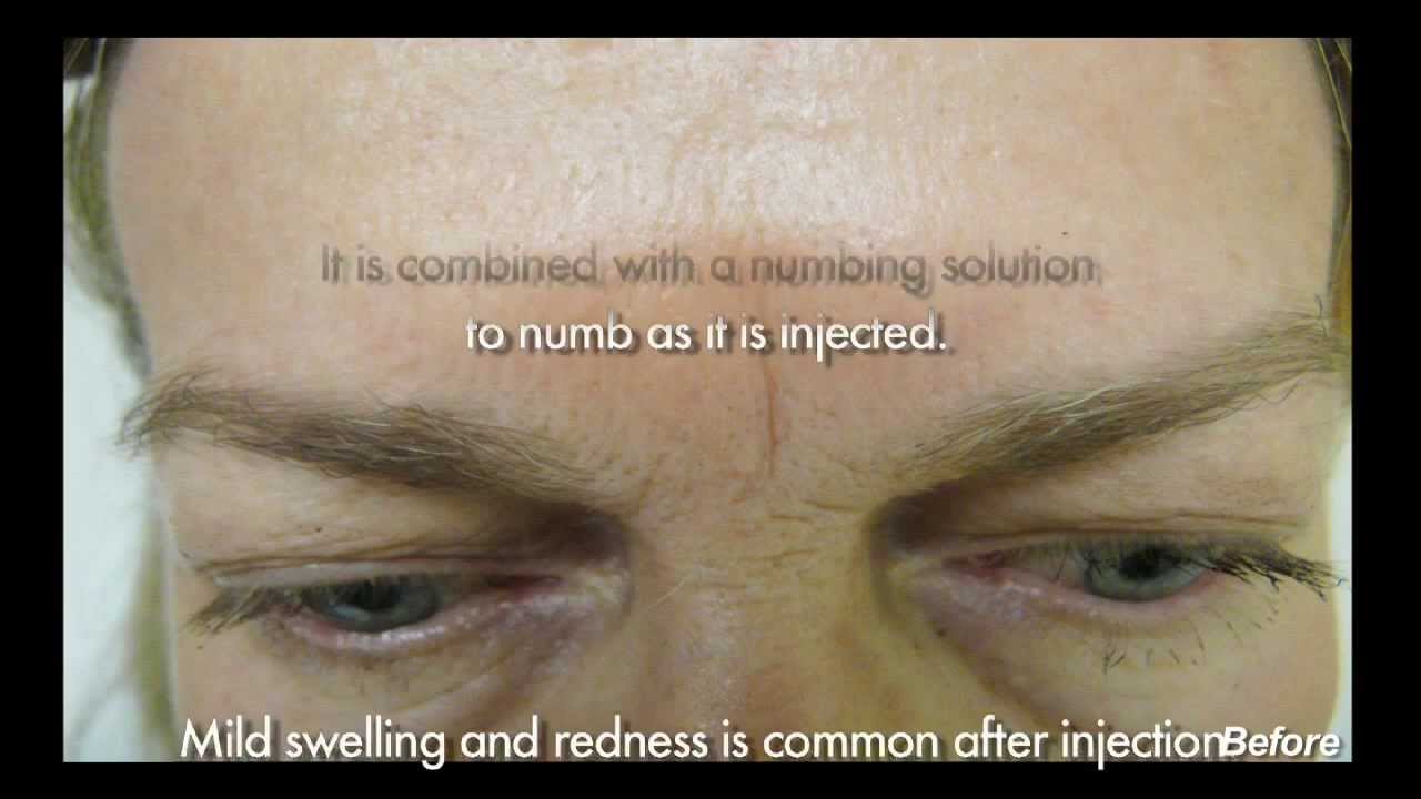 Non-surgical Jowl Lift Treatments in LA - FineTouch Dermatology