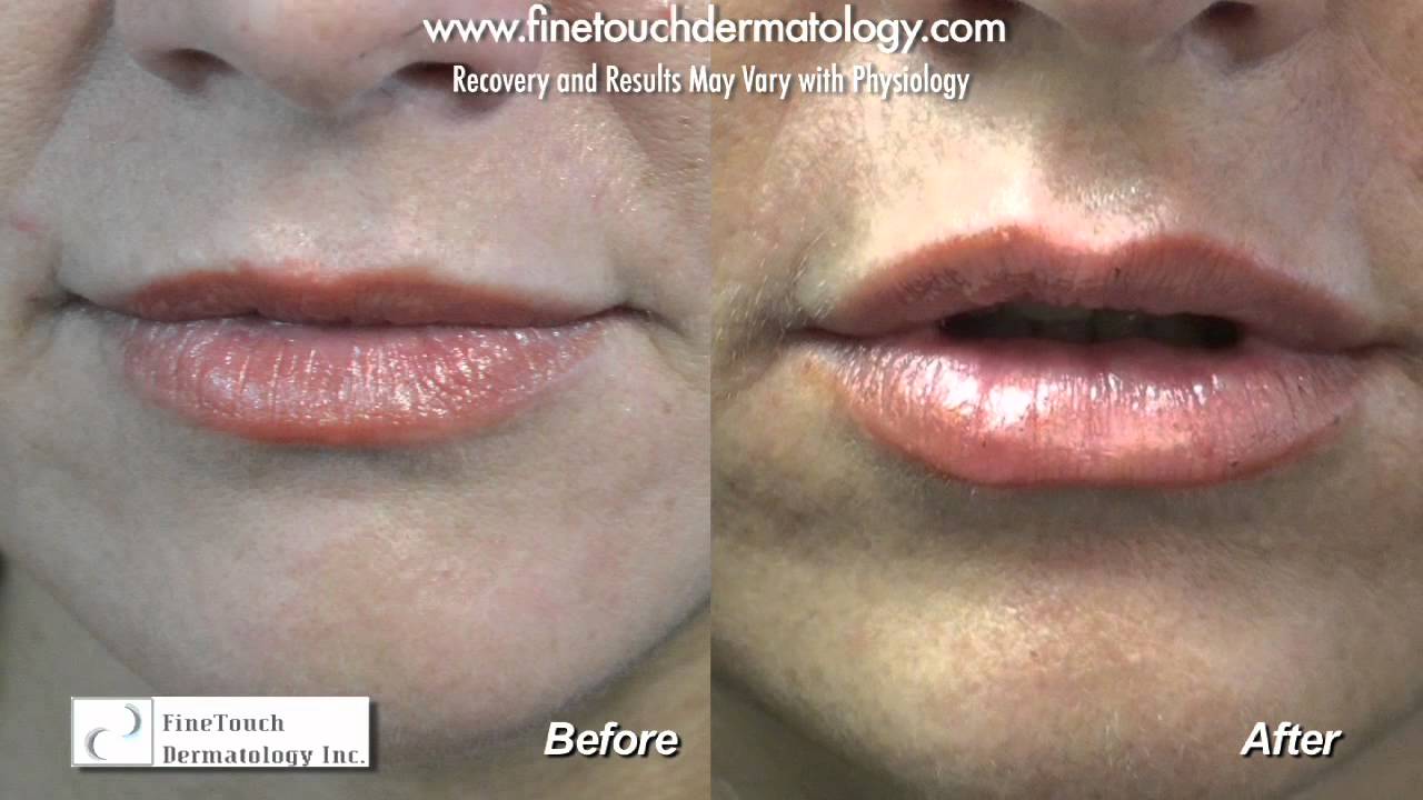 Getting Fuller and Shapely Lips