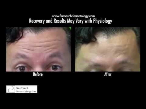 How to Get Rid of “Angry Face” - FineTouch Dermatology