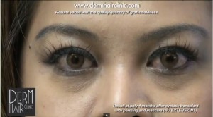Eyelash Transplant - Photos of Patient Before and After Surgery