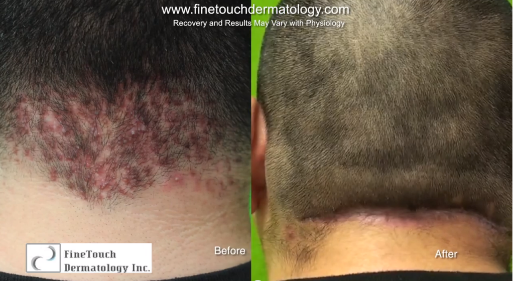 Acne Keloidalis Nuchae also called AKN, What Patients Should Know and More