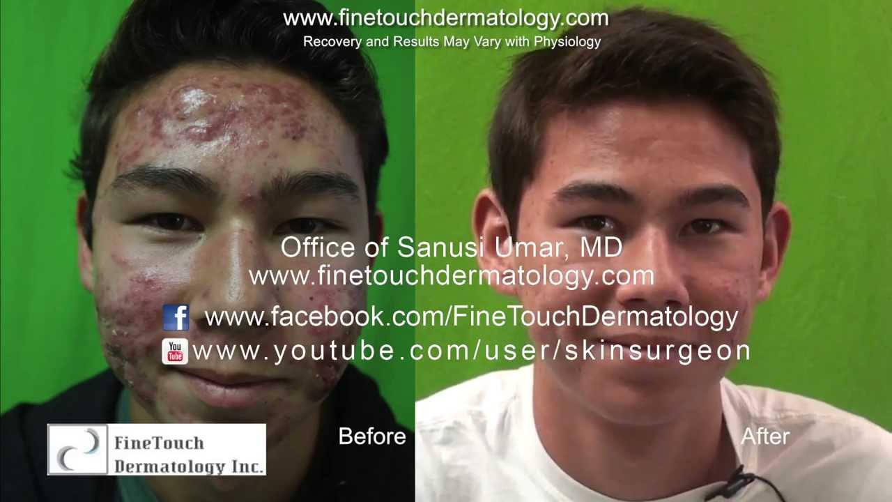 Photodynamic acne treatment