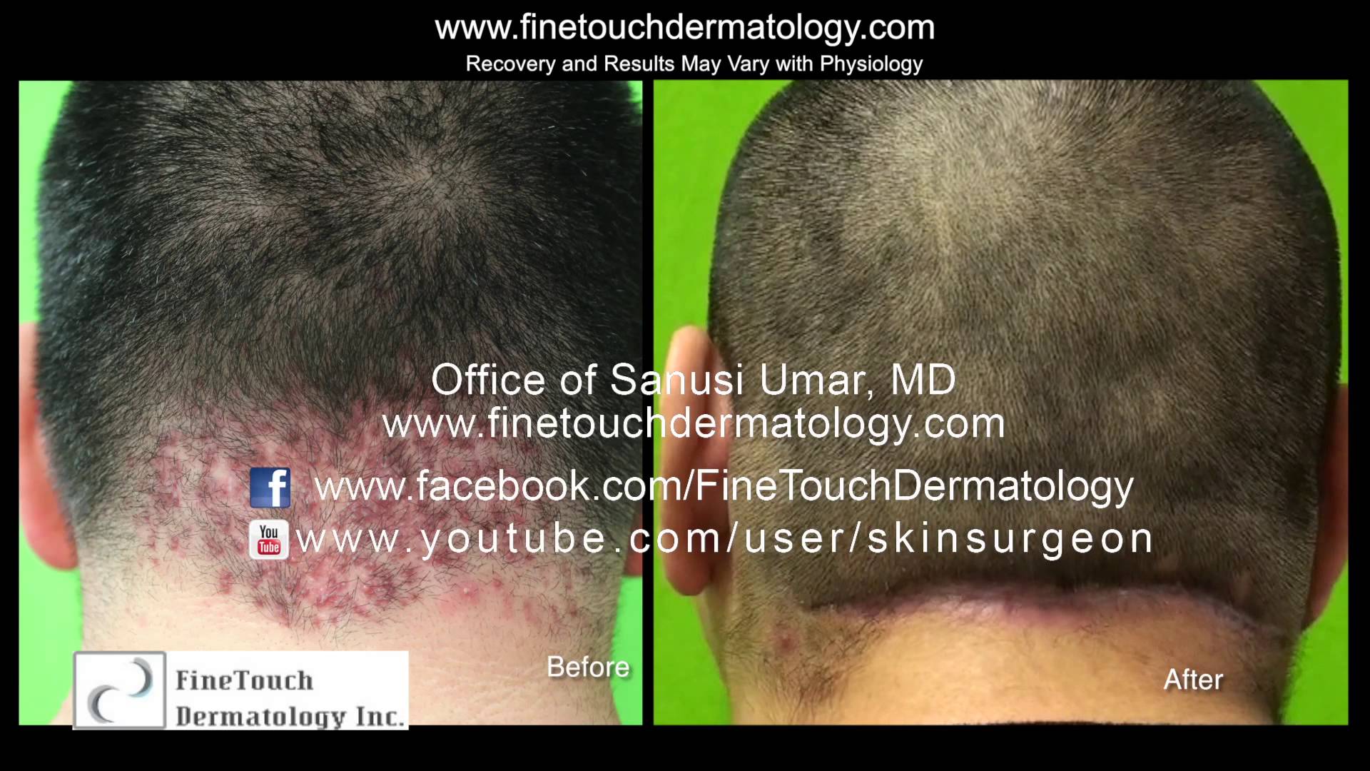 AKN Surgery Results After Scalp Bumps Removal By Dr Umar