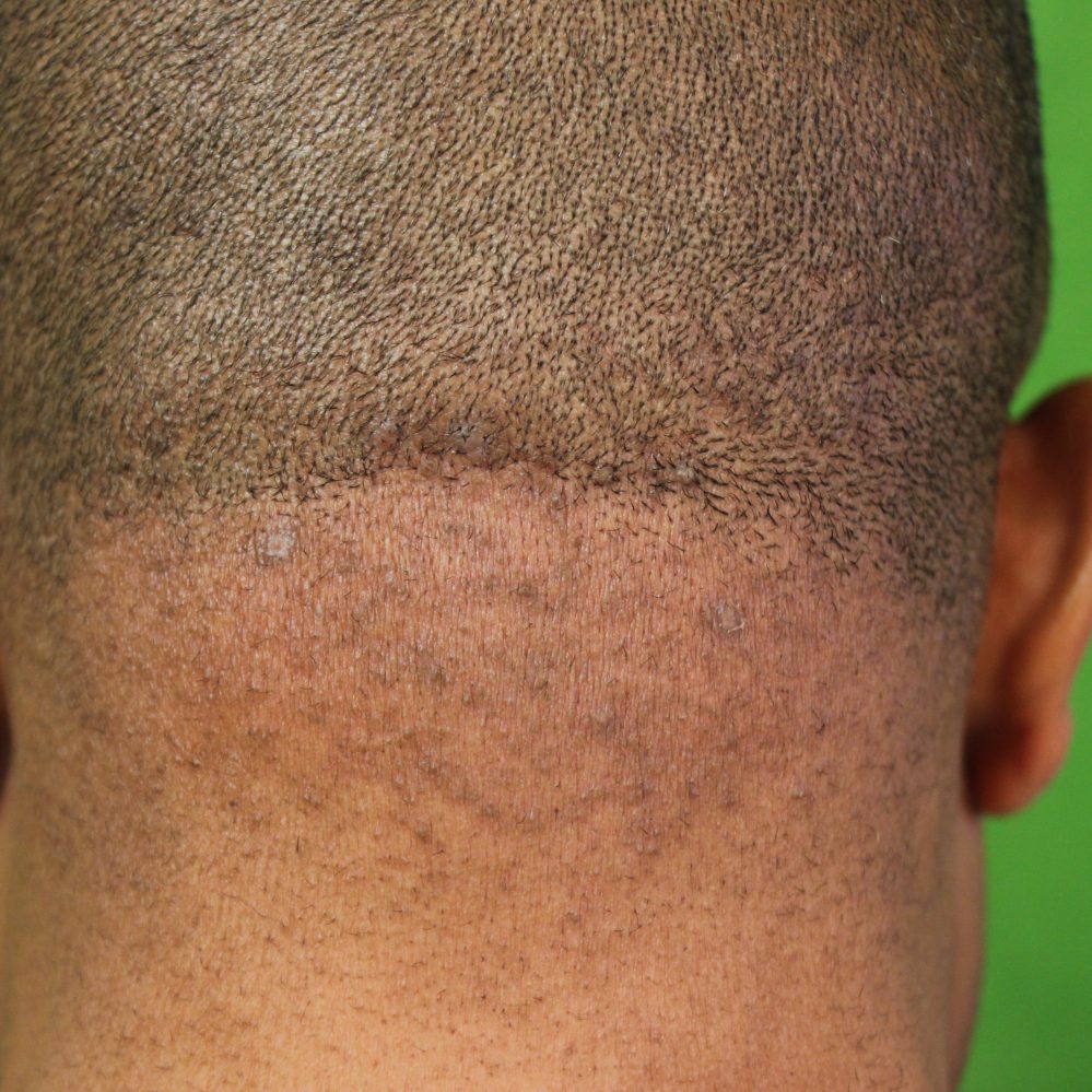 Acne Keloidalis Nuchae also called AKN, What Patients Should Know and More