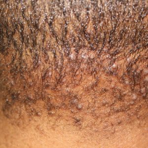 Acne Keloidalis Nuchae also called AKN, What Patients Should Know and More
